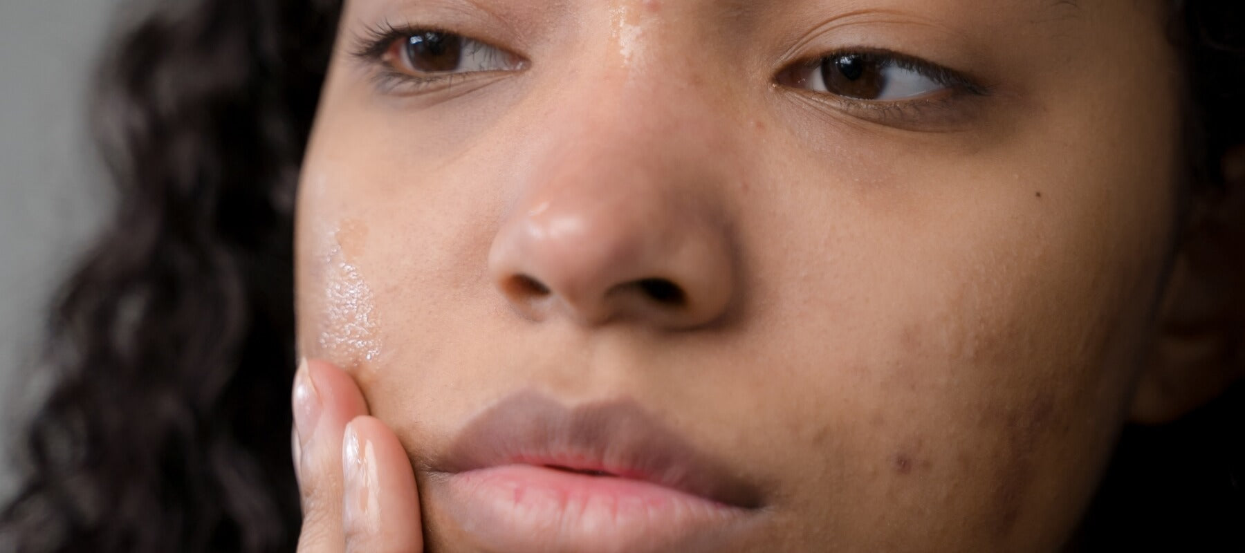 Optimum Health | Do You Struggle With Acne Scars?